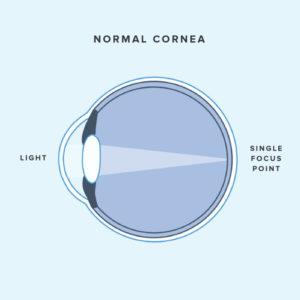 What Is Astigmatism & Can It Be Corrected? | Warby Parker