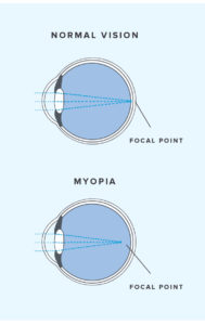 What is Myopia (Nearsightedness)? | Warby Parker