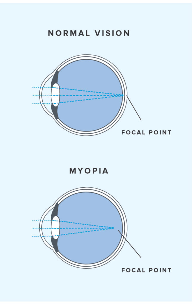What is Myopia (Nearsightedness)? | Warby Parker
