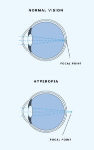 What Is Farsightedness (Hyperopia)? | Warby Parker