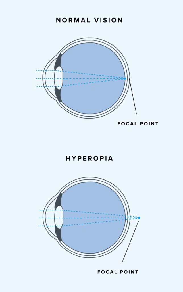 What Is Farsightedness (Hyperopia)? | Warby Parker