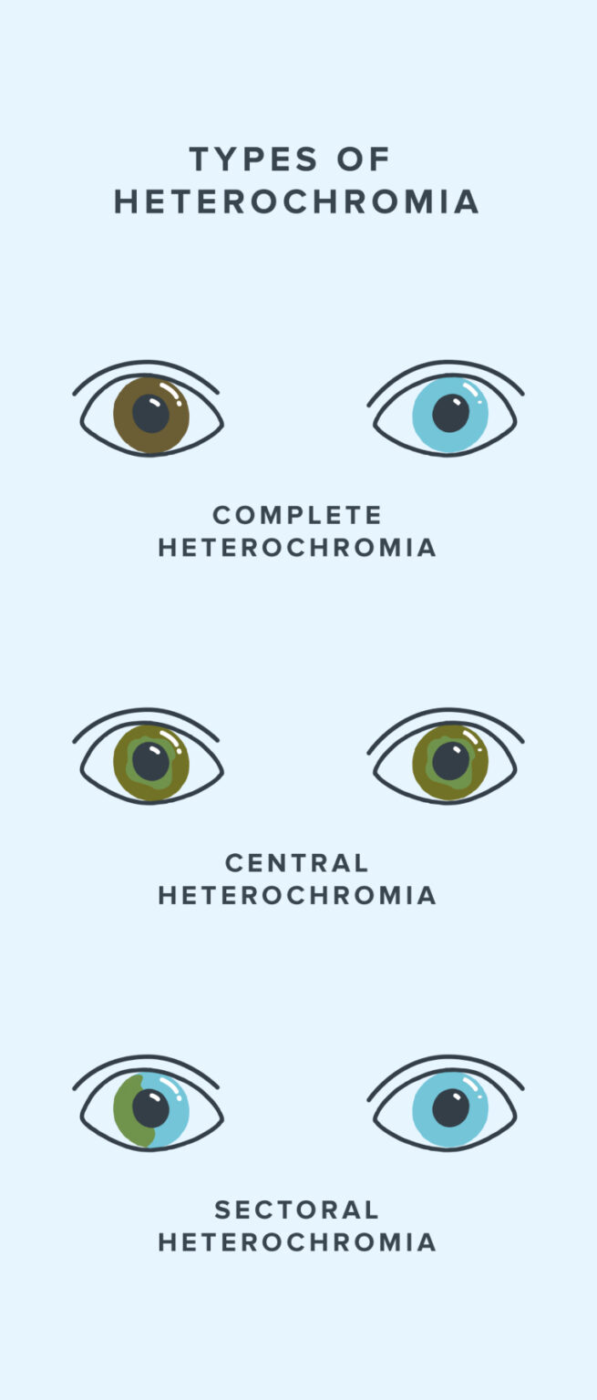 What Is Heterochromia of the Eyes? | Warby Parker