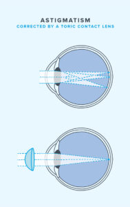 What Are Toric Contact Lenses? | Warby Parker
