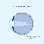 Eye Floaters: Definition, Causes, and Treatments | Warby Parker