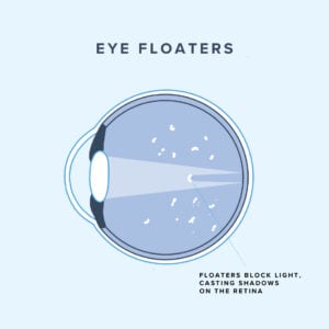 Eye Floaters: Definition, Causes, and Treatments | Warby Parker