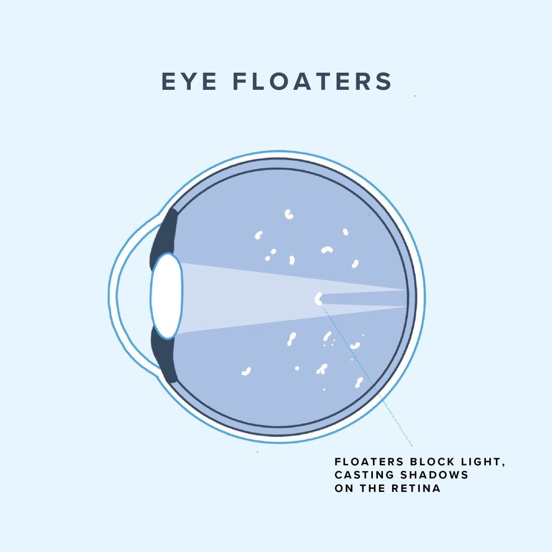 Eye Floaters: Definition, Causes, and Treatments | Warby Parker