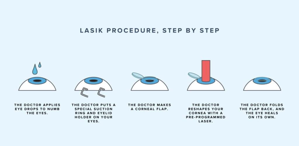 What Is LASIK Eye Surgery? | Warby Parker