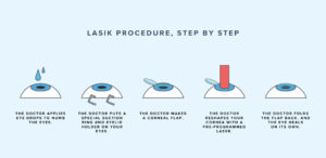 What Is LASIK Eye Surgery? | Warby Parker