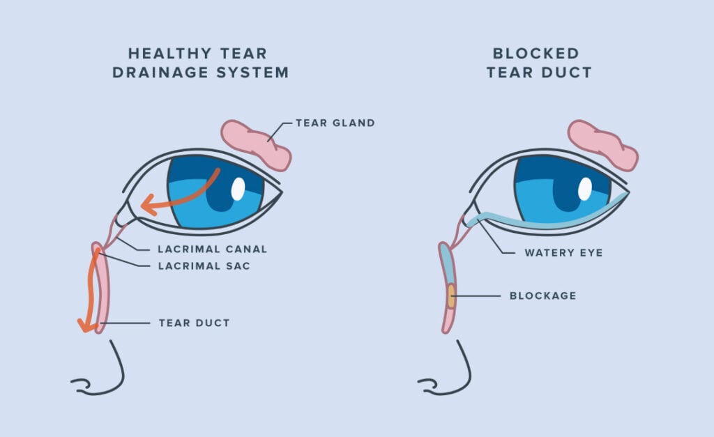 What Is a Blocked Tear Duct? | Warby Parker