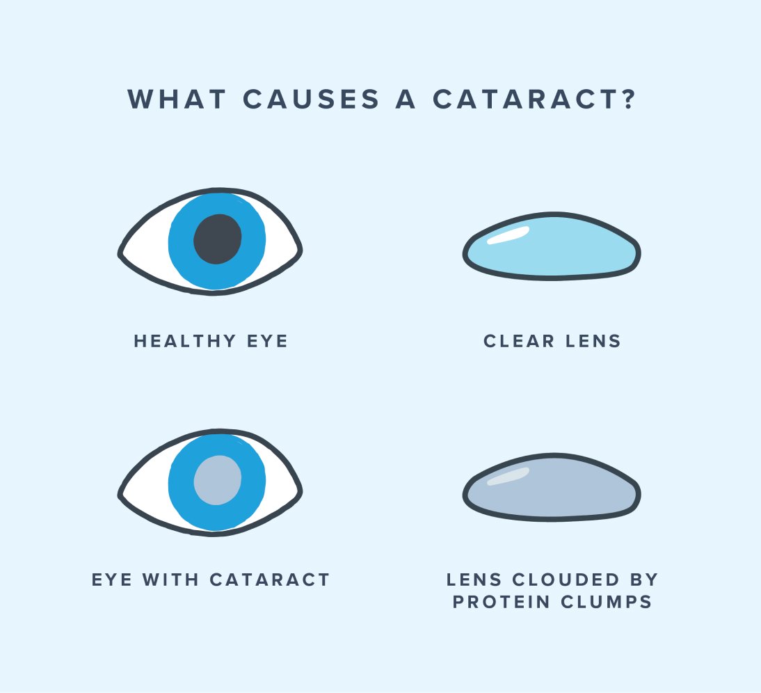 What Are Cataracts? | Warby Parker