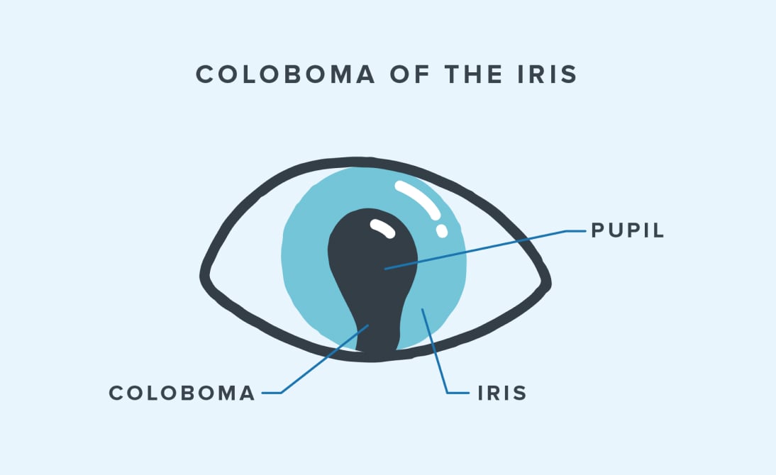 Rare Eye Diseases | Warby Parker