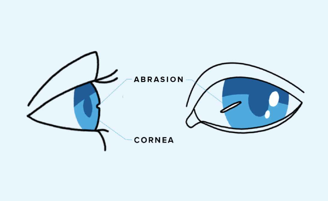 Common Eye Problems | Warby Parker