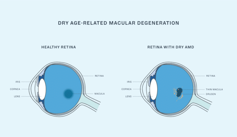Wet vs. Dry Macular Degeneration: Symptoms and Treatment | Warby Parker