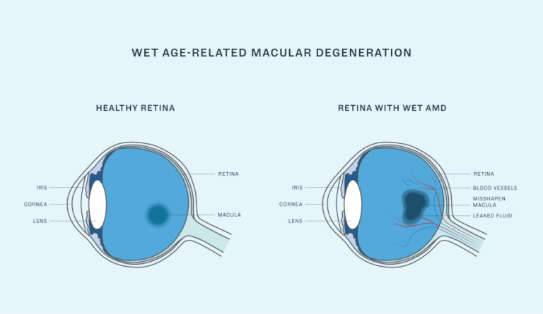 Wet vs. Dry Macular Degeneration: Symptoms and Treatment | Warby Parker