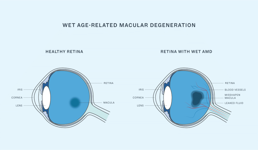 Wet vs. Dry Macular Degeneration: Symptoms and Treatment | Warby Parker