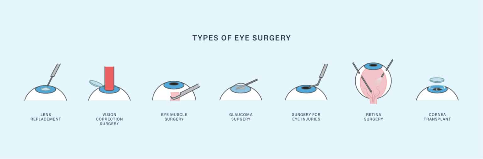 Eye Surgeries: Types, Procedures, Costs, and Recovery | Warby Parker