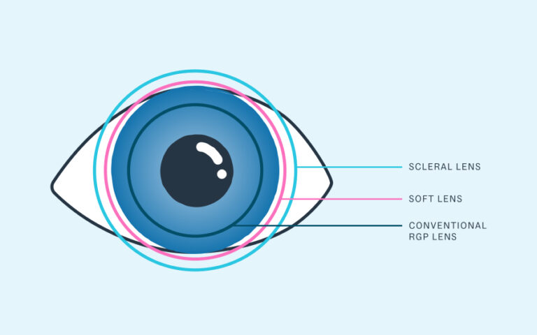 Scleral Lenses: Benefits and Uses for Eye Conditions | Warby Parker